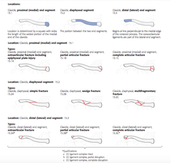 Clavicle (Collar Bone) Fracture - Frisco, TX - Knee, Hip, Shoulder ...