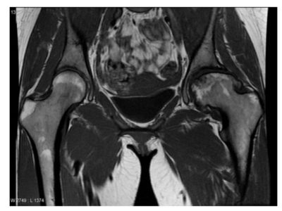 Avascular Necrosis (AVN) of the Femoral Head (Hip Osteonecrosis ...