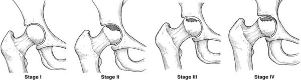 Avascular Necrosis (AVN) of the Femoral Head (Hip Osteonecrosis ...