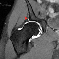 Acetabular Labral Tears | Frisco, TX | Orthopedic Surgeon