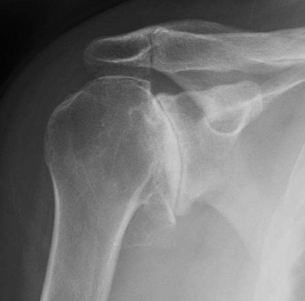 Shoulder Arthritis (Glenohumeral Arthritis) | Frisco, TX | Orthopedic ...