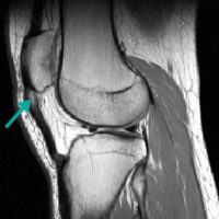 Patellar Tendonitis (Jumper’s Knee) | Frisco, TX | Orthopedic Surgeon