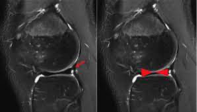 Discoid Meniscus - Frisco, TX - Knee, Hip, Shoulder, Joint Surgery