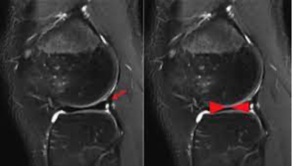 Discoid Meniscus - Frisco, TX - Knee, Hip, Shoulder, Joint Surgery