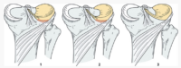 Discoid Meniscus - Frisco, TX - Knee, Hip, Shoulder, Joint Surgery