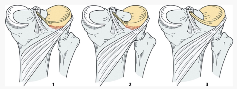 Discoid Meniscus - Frisco, TX - Knee, Hip, Shoulder, Joint Surgery