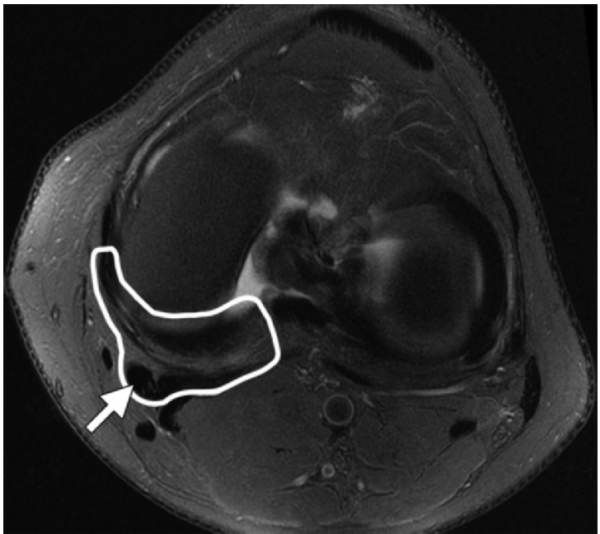 Posteromedial Corner (PMC) of the Knee Injuries - Frisco, TX - Knee ...