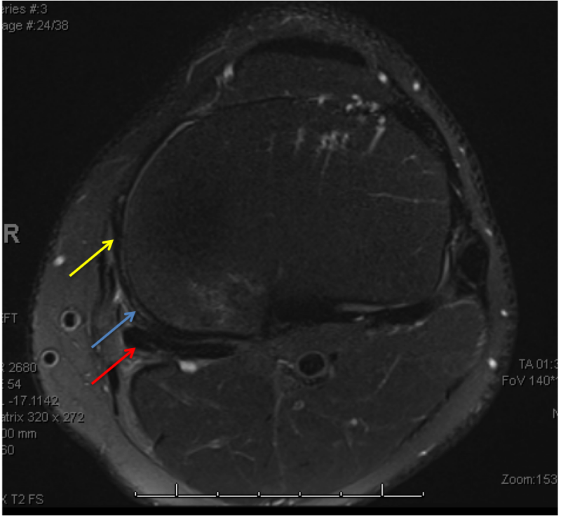 Posteromedial Corner (PMC) of the Knee Injuries - Frisco, TX - Knee ...
