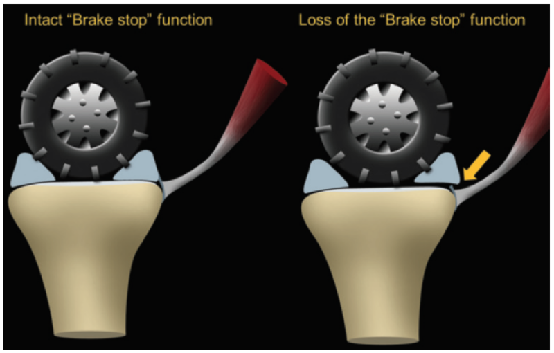 Posteromedial Corner (PMC) of the Knee Injuries - Frisco, TX - Knee ...